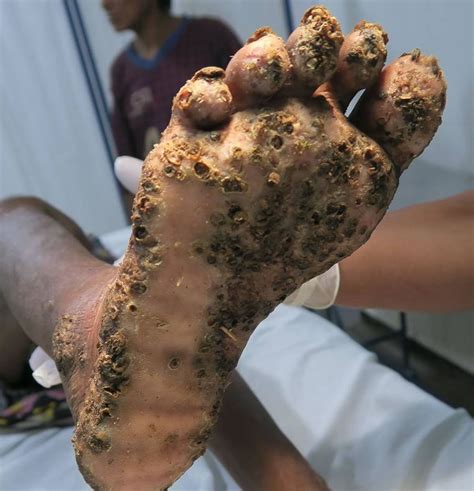 Tungiasis Causes Symptoms Diagnosis Treatment And Prognosis