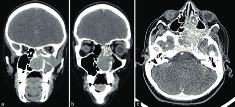 A C A Large Ill Defined Heterogeneously Enhancing Soft Tissue Density