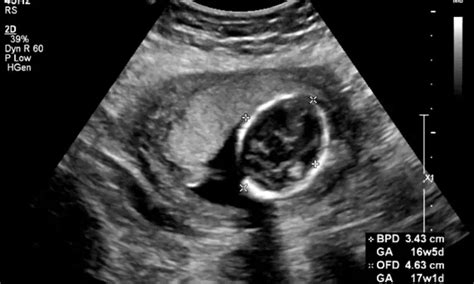 AI Based Analysis Of Ultrasound Images And Videos Predicts Gestational Age More Accurately Study