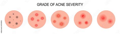 Grade Of Acne Severity Medical Diagram Different Types Acne