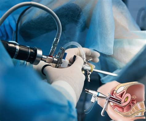 Bartholins Cyst Specialist In Birmingham Your Gynae Health
