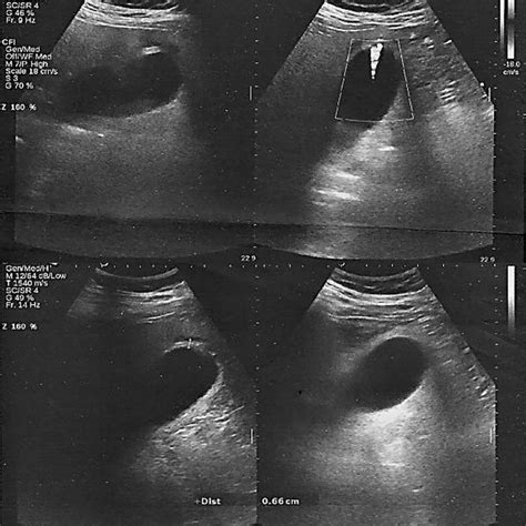 Abdominal Ct Scan Marked Gallbladder Dilatation And Wall Thickening