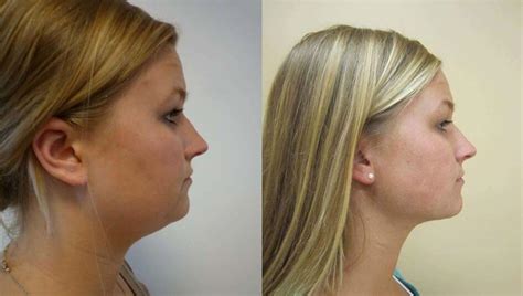 Neck Lift Cost 2024 Flore Jillana