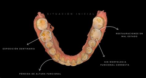 Occlusion Reconstruction In Teeth Abrasion Case Shining 3d Dental