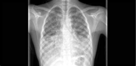 Chest Radiograph Showing Extensive Bilateral Infiltrates Download Scientific Diagram
