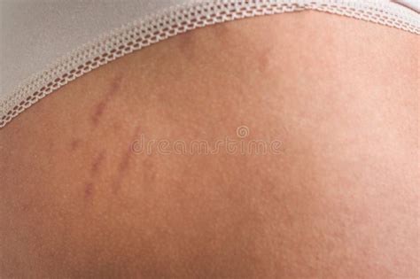 Young Woman Shows Her Cellulite And Stretch Marks On White Isolated