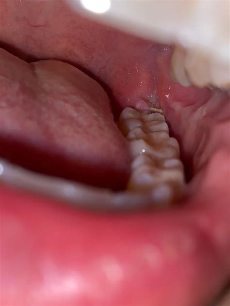 Hey Guys Im 3 4 Days Post Wisdom Teeth Extraction Does This Look Like
