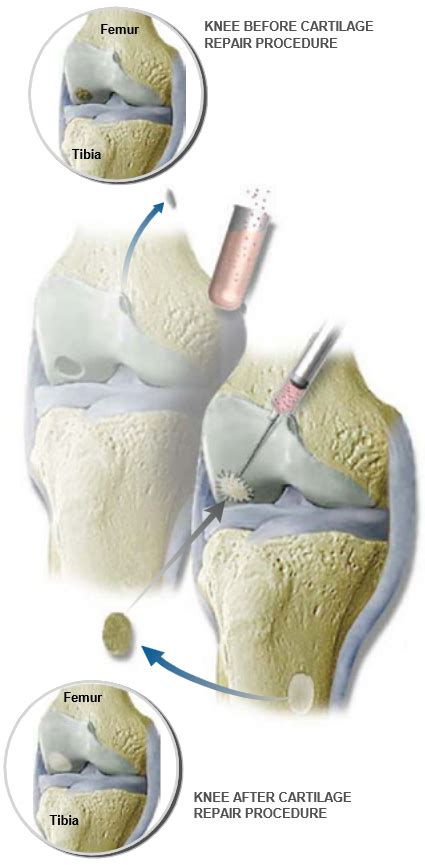 Cartilage Repair Central Coast Orthopedic Medical Group