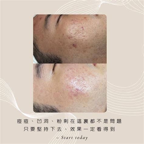 𝐁𝐥𝐞𝐬𝐬 𝐀𝐞𝐬𝐭𝐡𝐞𝐭𝐢𝐜專業皮膚管理中心 以前站專櫃的我不可能不化妝就出門，皮膚的蠟黃暗沈、毛孔、敏感泛紅、顆粒感，這些問題超級困擾