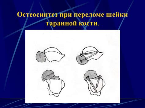 Переломы костей стопы презентация онлайн