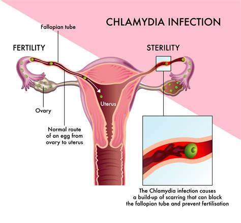 Can Chlamydia Cause Infertility Cherokee Womens Health