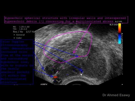 Imaging Prostatitis Urethritis Dr Ahmed Esawy Ppt