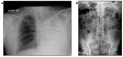 Pseudomembranous Colitis X Ray