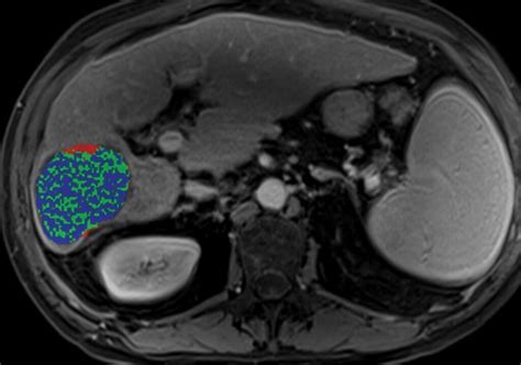 Unresectable Intrahepatic Cholangiocarcinoma Multiparametric Mr