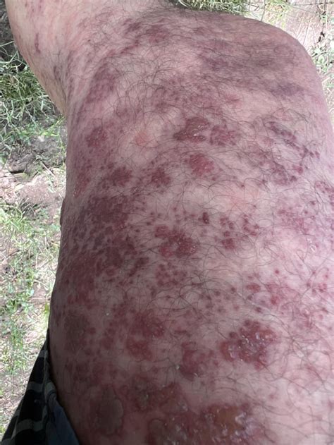 Is This Shingles R Shingles