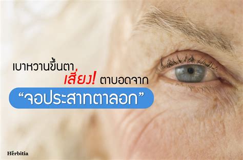 เบาหวานขึ้นตา เสี่ยงตาบอด จาก “จอประสาทตาลอก” Herbitia