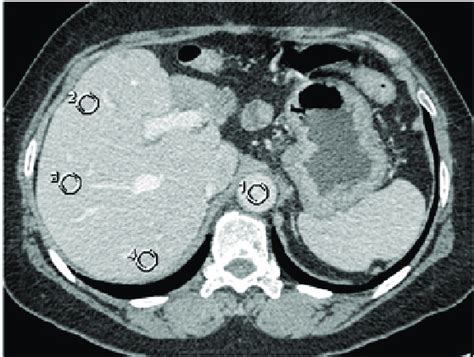 In Case Of Post Left Hepatectomy The 3 Hepatic Rois Were Placed In