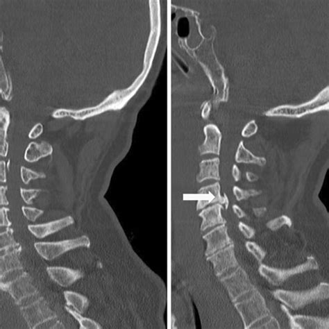 Figure4postoperative Ct C3 Laminectomy And C4 6 Laminoplasty Were