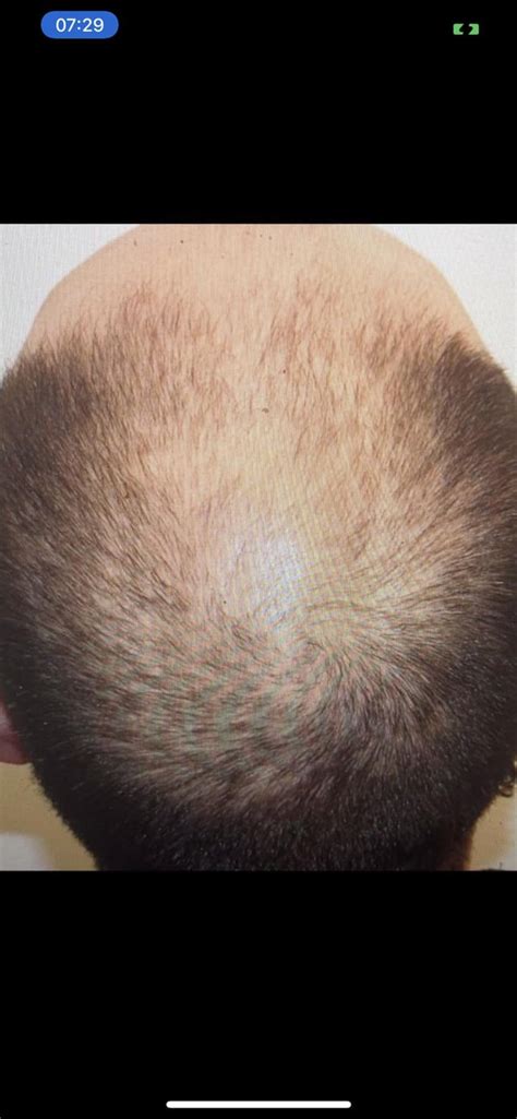 My Hair Transplant Journey So Far 7 400 Grafts Nw6 Fueclinic R