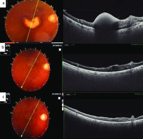 A Right Eye Optical Coherence Tomography Oct Showing Download