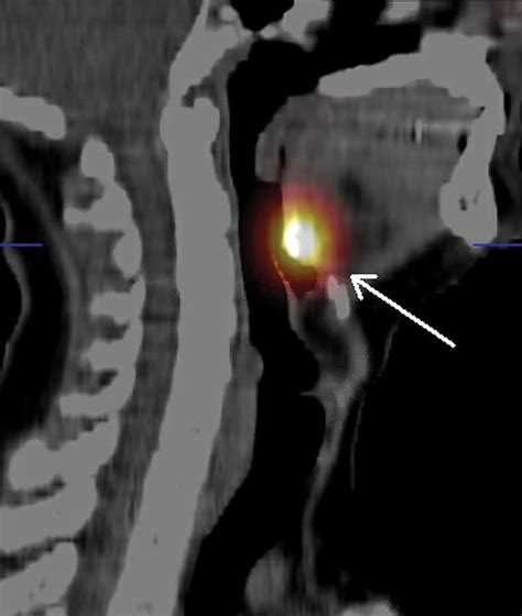 A Rare Case Of Lingual Thyroid In A Man Applied Radiology
