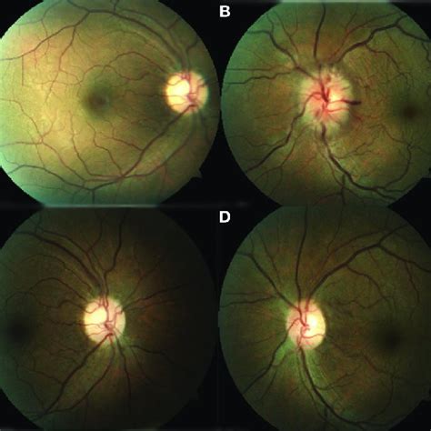 Correlation Between The Ganglion Cell Layer Gcl Retinal Nerve Download Scientific Diagram