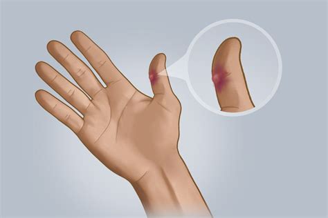 Osler结节图片 39健康网