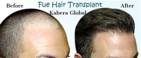 Low Density Hair Transplant Velda Blythe