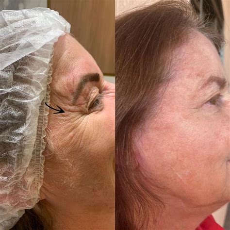 Botox Antes E Depois Em 20 Fotos