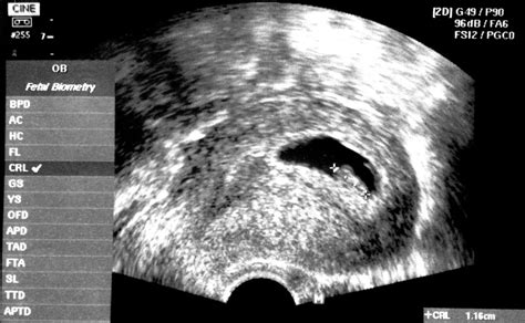 Week Ultrasound The Early Gestational Sac Ultrasound Off