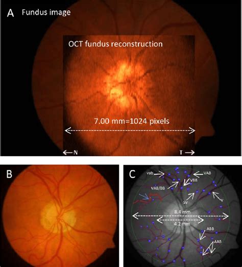 Calibration And Recognition Of The Retinal Vessels On Fundus Image Of A Download Scientific