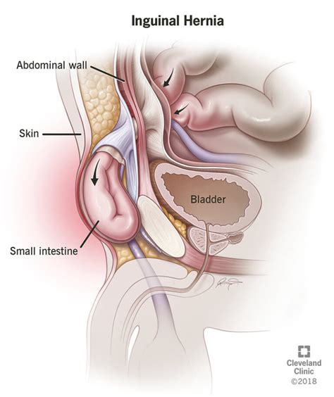 Anatomical Diagrams Of Inguinal Hernia Holistic Hernia Remediation