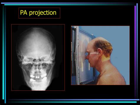 Ppt Skull Positioning Dmi 55 Powerpoint Presentation Free Download