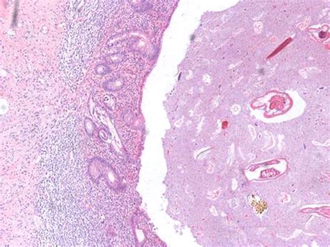 Eosinophilic Acute Appendicitis Caused By Strongyloides Stercoralis And