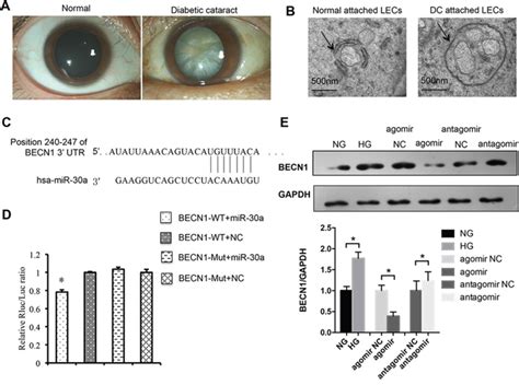 Mir 30a Inhibits Becn1 Mediated Autophagy In Diabetic Cataract Oncotarget