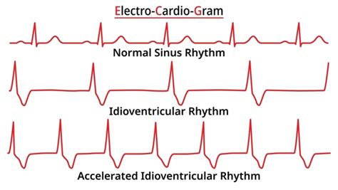 Idioventricular Rhythm