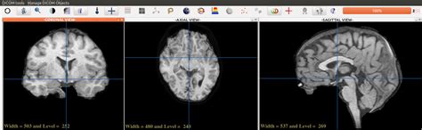 How To Use The Brain Extraction Tool