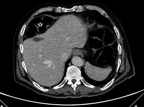 Computed Tomography Axial Section Showing The Anterior Interposition