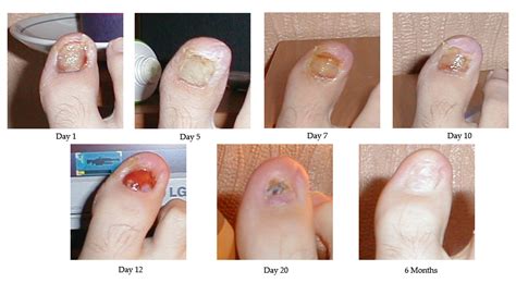Partial Nail Avulsion