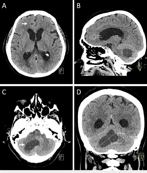 Ct Of Metastatic Brain Disease A And C Axial Views Metastatic Lesion
