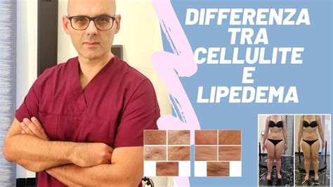Differenza Tra Cellulite E Lipedema Youtube
