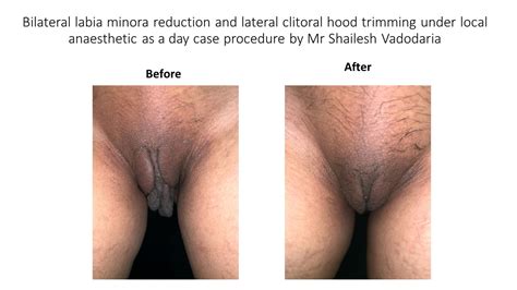 A Patients Personal Story Is Labia Minora Reduction Labiaplasty Is