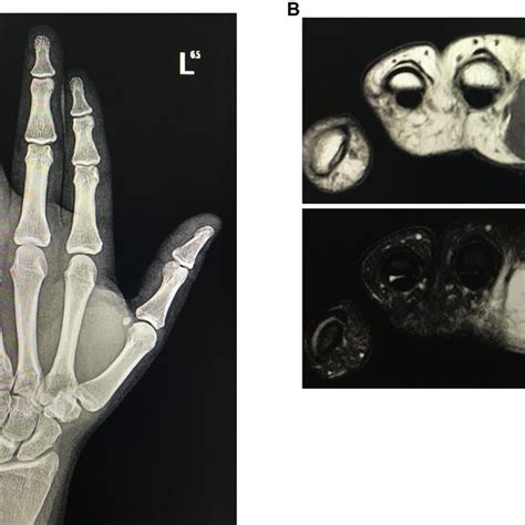 Clinical Presentation Of Digit Fibro Osseous Pseudotumor Mass It Shows Download Scientific