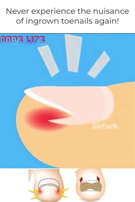 Ingrown Toenails 6 Surprisingly Effective Home Remedies Artofit