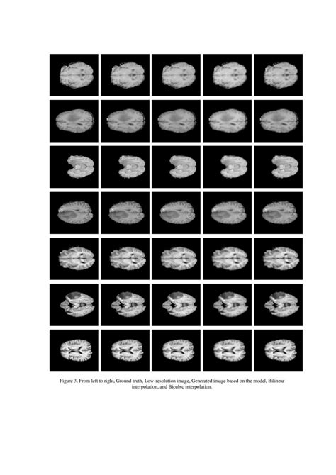 single mr image super resolution using generative adversarial network
