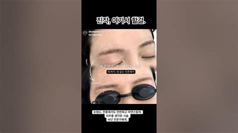 잔흔제거도 신중히 하세요 피부를 생각한 안전한 잔흔제거 눈썹문신제거 노원잔흔제거 Youtube