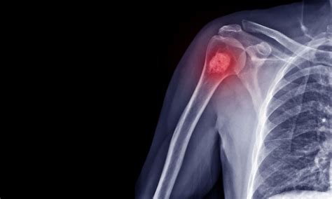 Nowotwór rak kości nietypowe objawy diagnoza leczenie rokowania