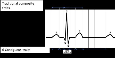 Illustration Of The Six Contiguous P Wave PR Segment QRS Interval Download Scientific