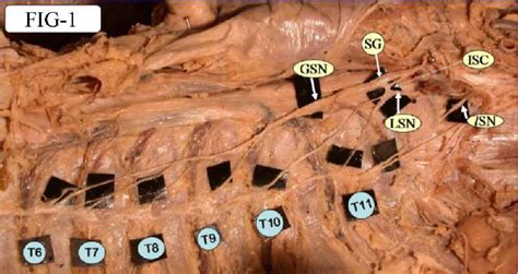 Figure 1 From Variations In The Formation Of Thoracic Splanchnic Nerves