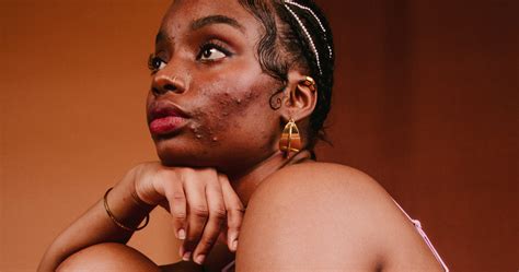 What Is Body Hyperpigmentation Causes And Treatment What Is Body Hyperpigmentation Causes And Treatment